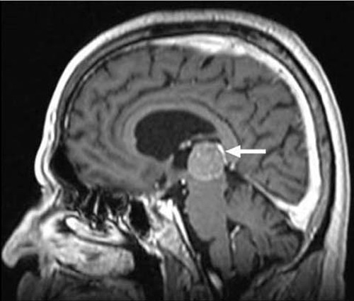 Pineal Gland Mri